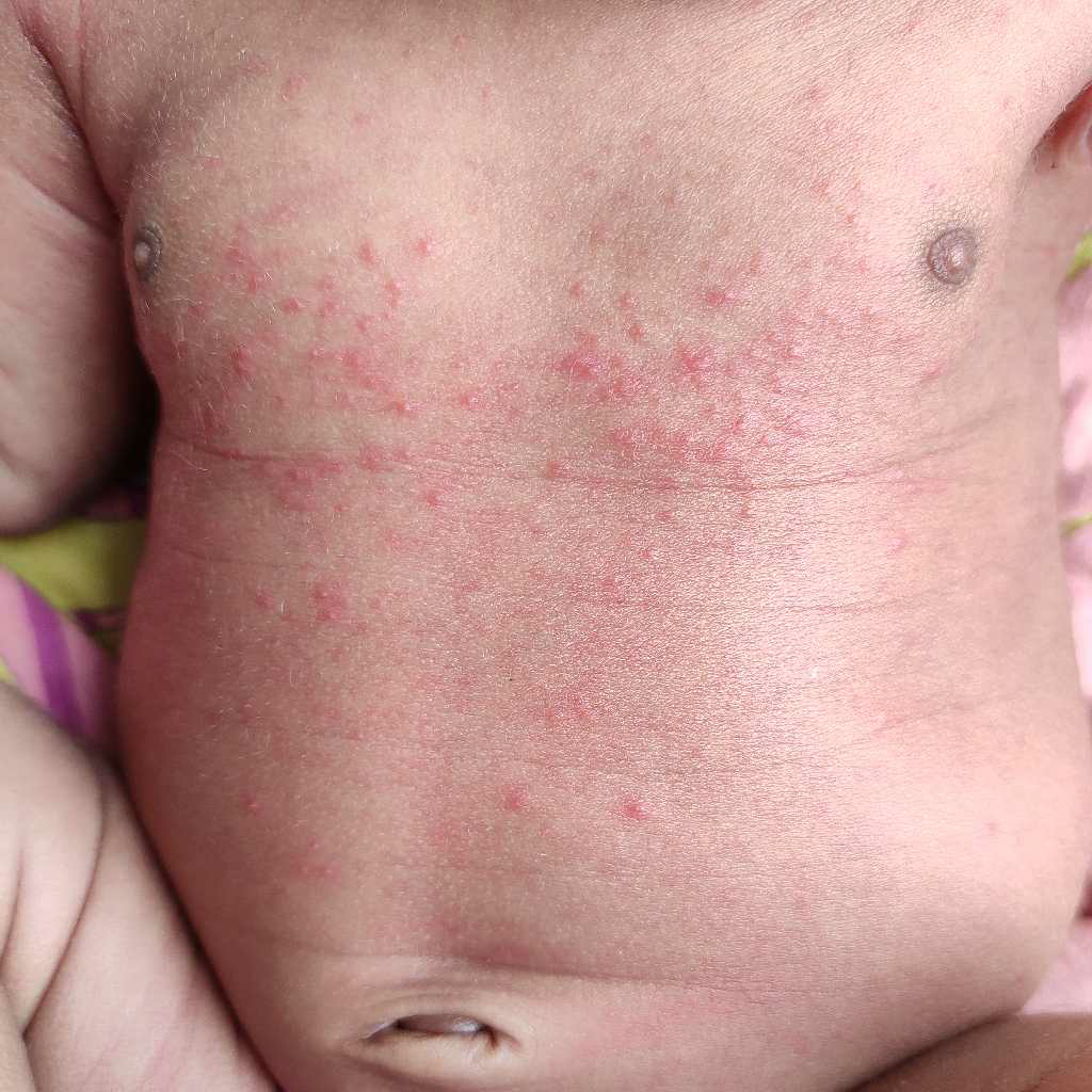  ParentingClinic GD Morning Sir Today Morning I Found These Red Rashes