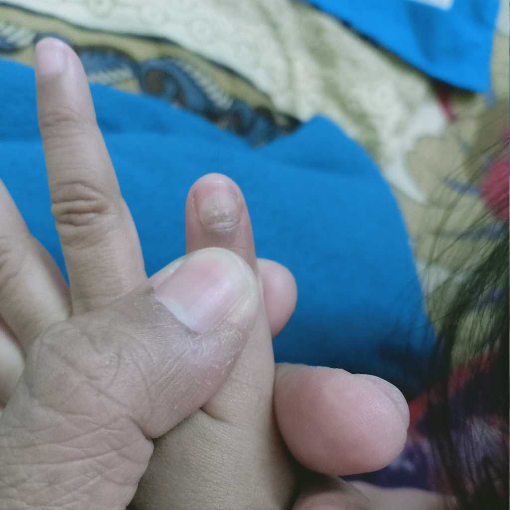 Hi Dr! I noticed that my daughter's (18 months), 1 of her nails is ...