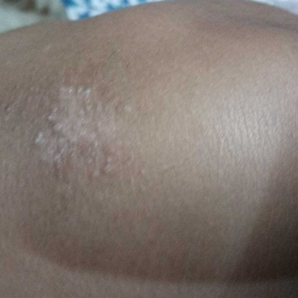 2y boy having rashes in under arms. What is the reason – FirstCry Parenting