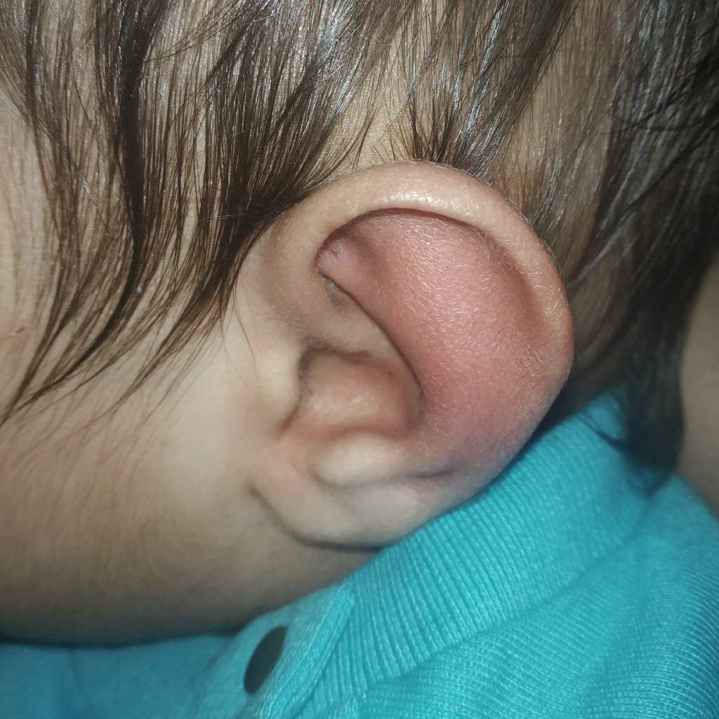 does ear will swell a baby check – FirstCry Parenting