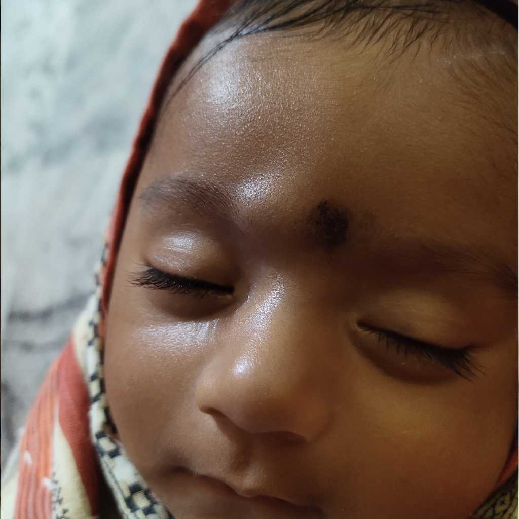 A blister type thing has been developed on the baby's forehead..Iam not ...