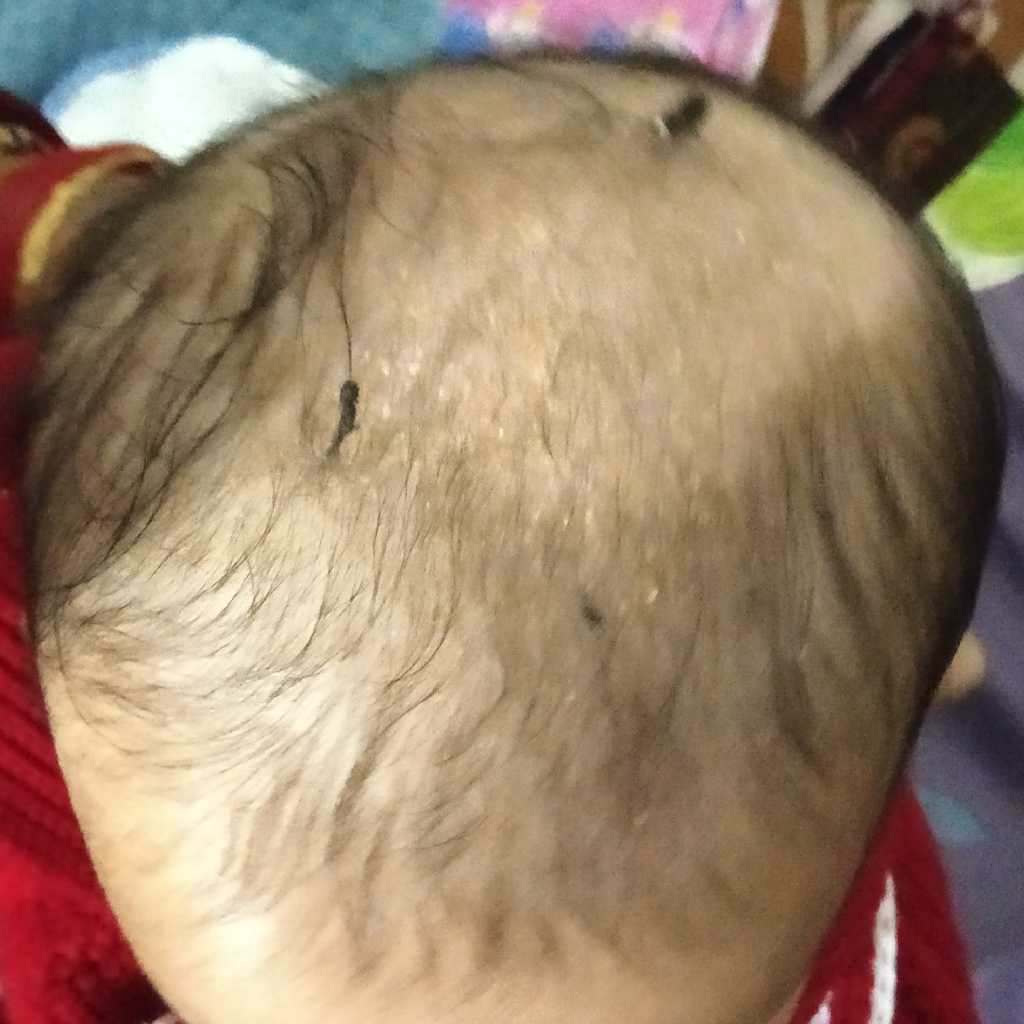 hi.. on my 3 months old baby head happened like this and losing hair ...