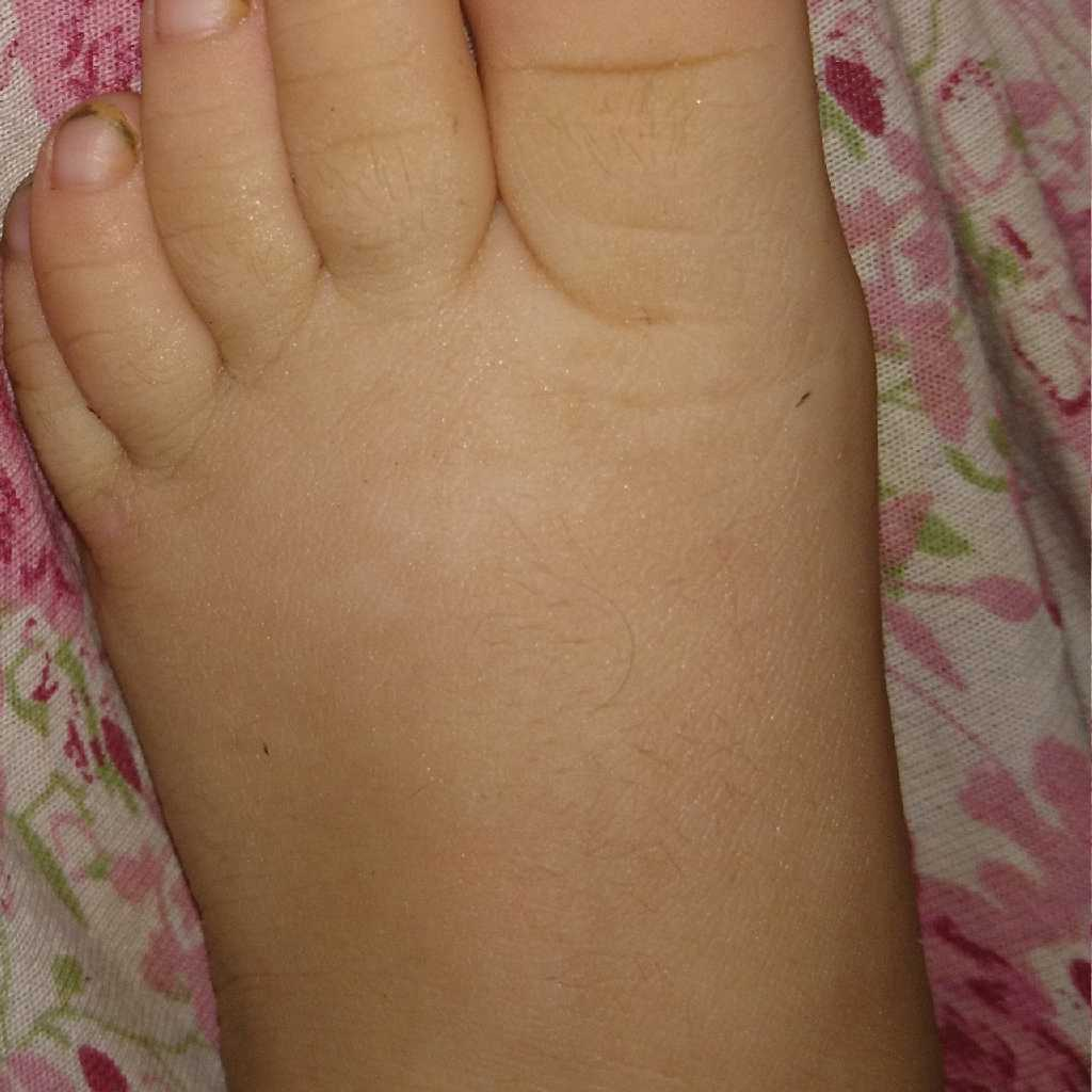 how can i know the difference between vitiligo and other white patches ...