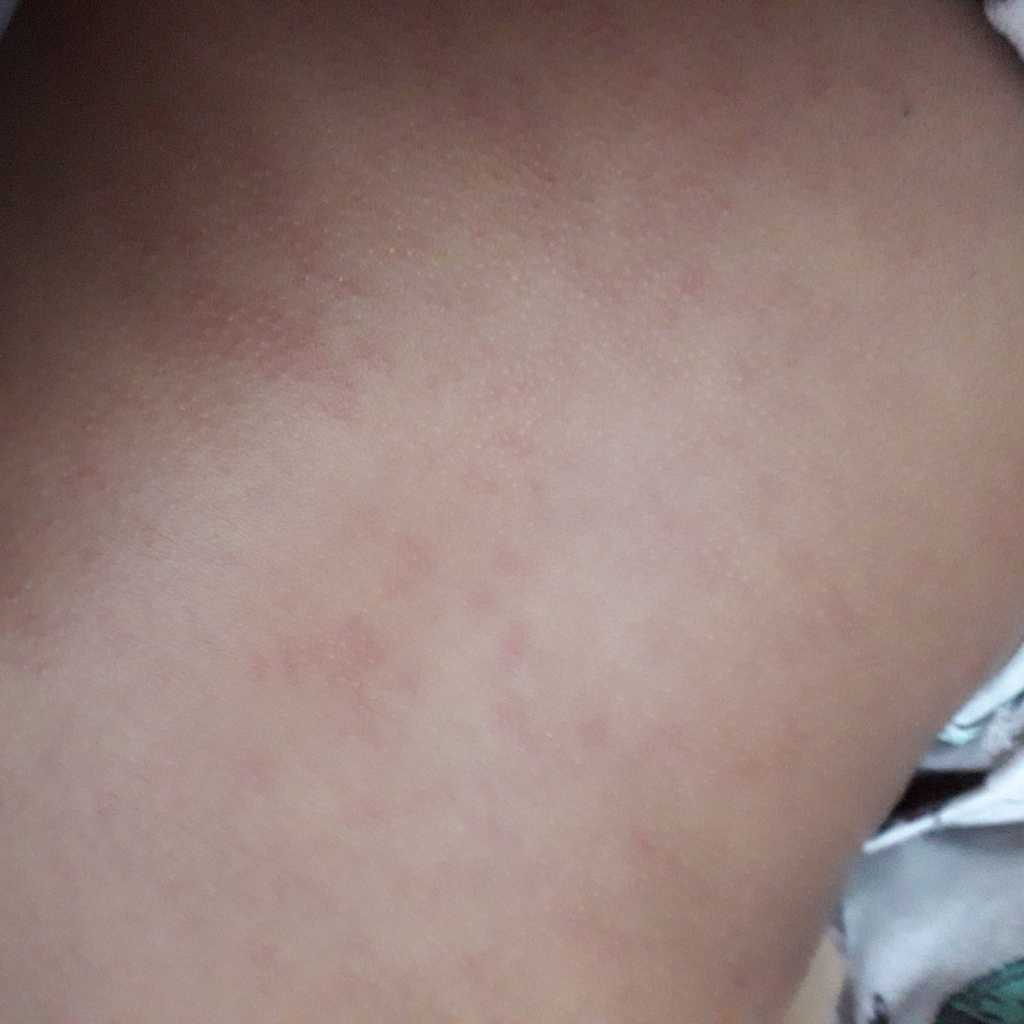 my baby is 5 months old she has diaper rashes, please suggest good ...