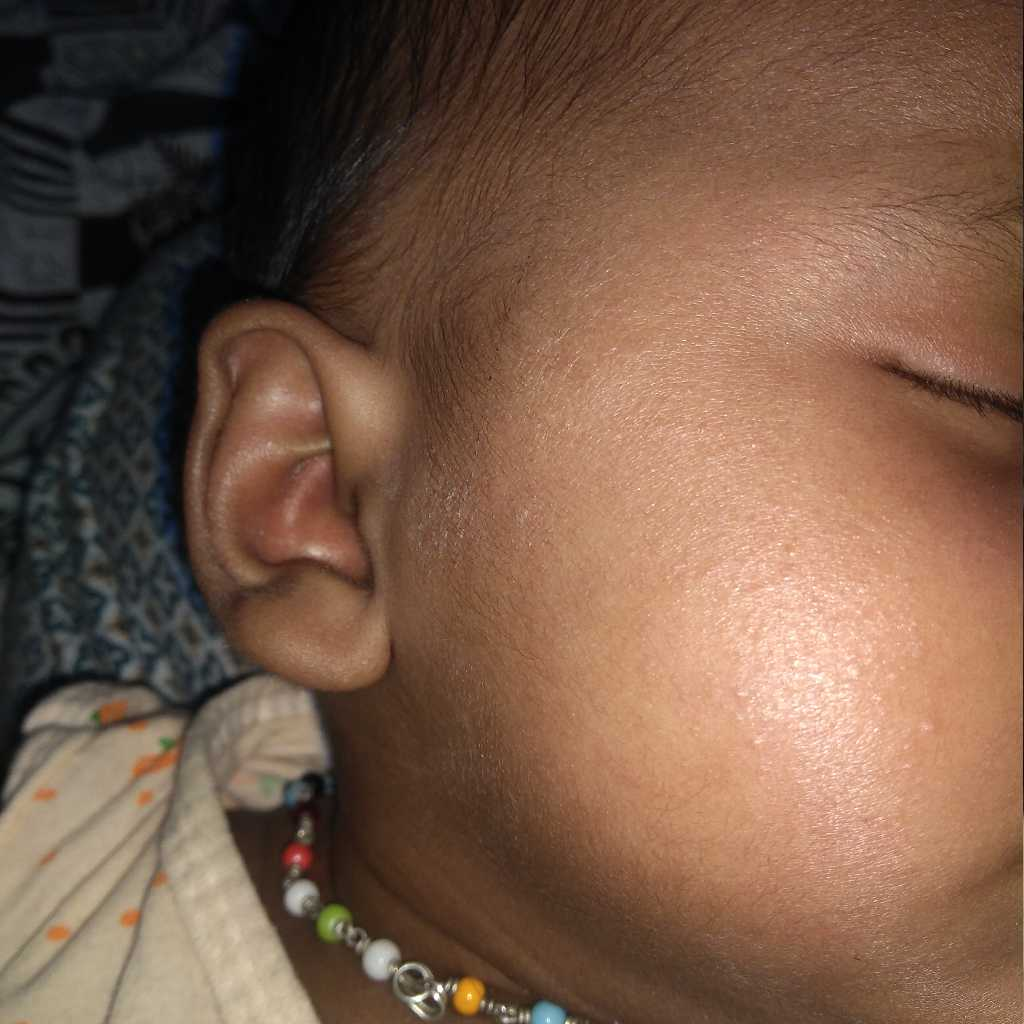 hi ,can you please suggest what cream to apply for rashes on face like ...