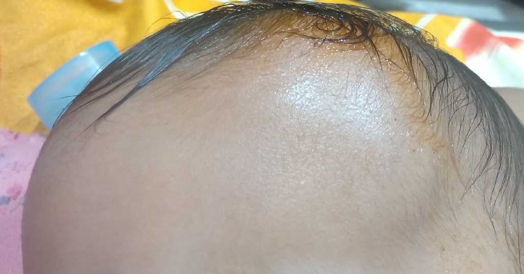 my 6 month baby was fallen from bed...he got hurt on his forehead and ...