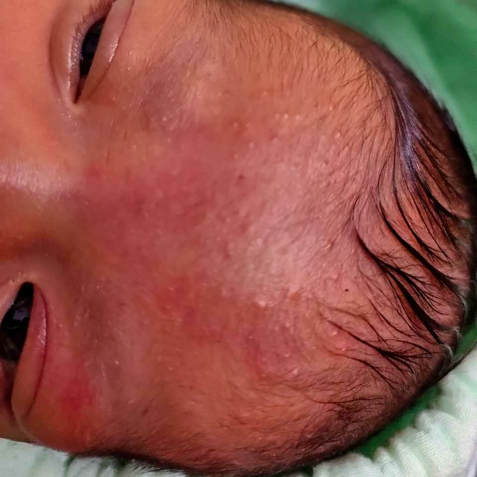 my baby is 1 month old. she has rashes on face and neck from 4 days ...