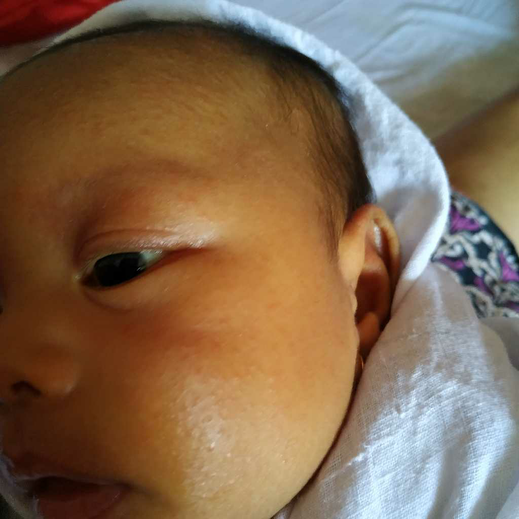 hi my baby is having rashes all over bady mostly on face suggest me ...