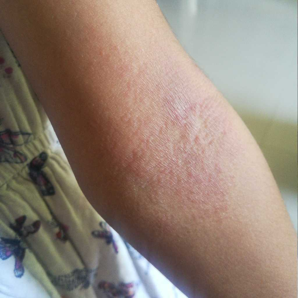 my son is 5 months old, his pennis is a bit curved and skin is slightly ...