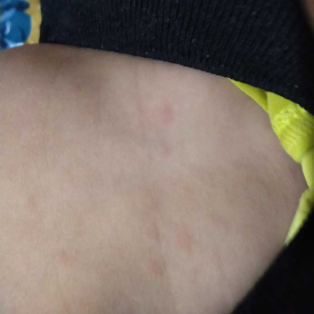 My baby(1.5 m old) has side effects after her 1st 6 in 1 shot (last ...