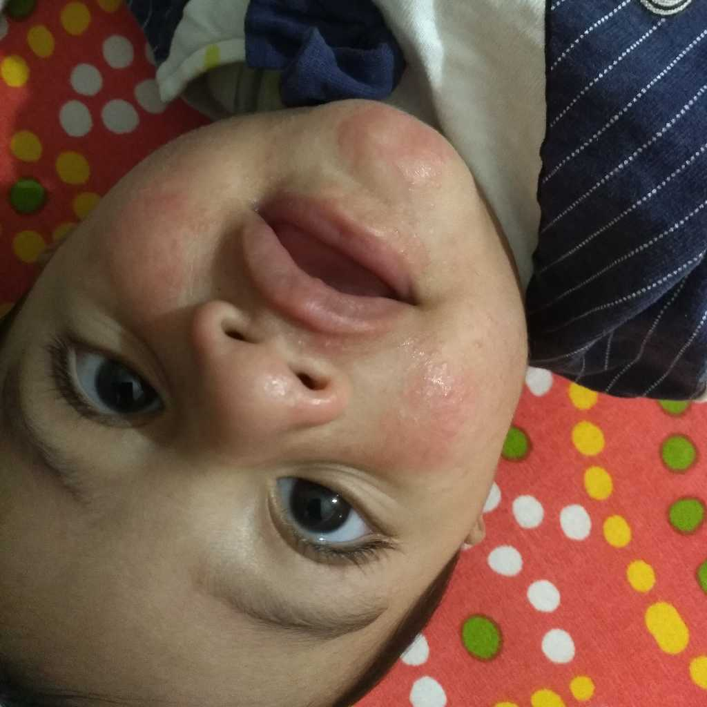 Rashes On Face In Children