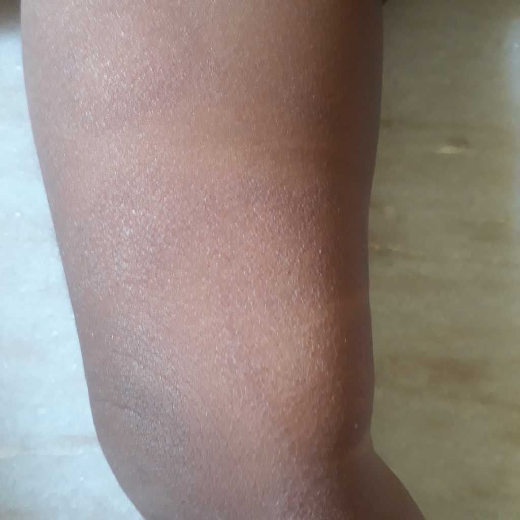 my baby got a rash on legs hands and back it looks like rough skin ...