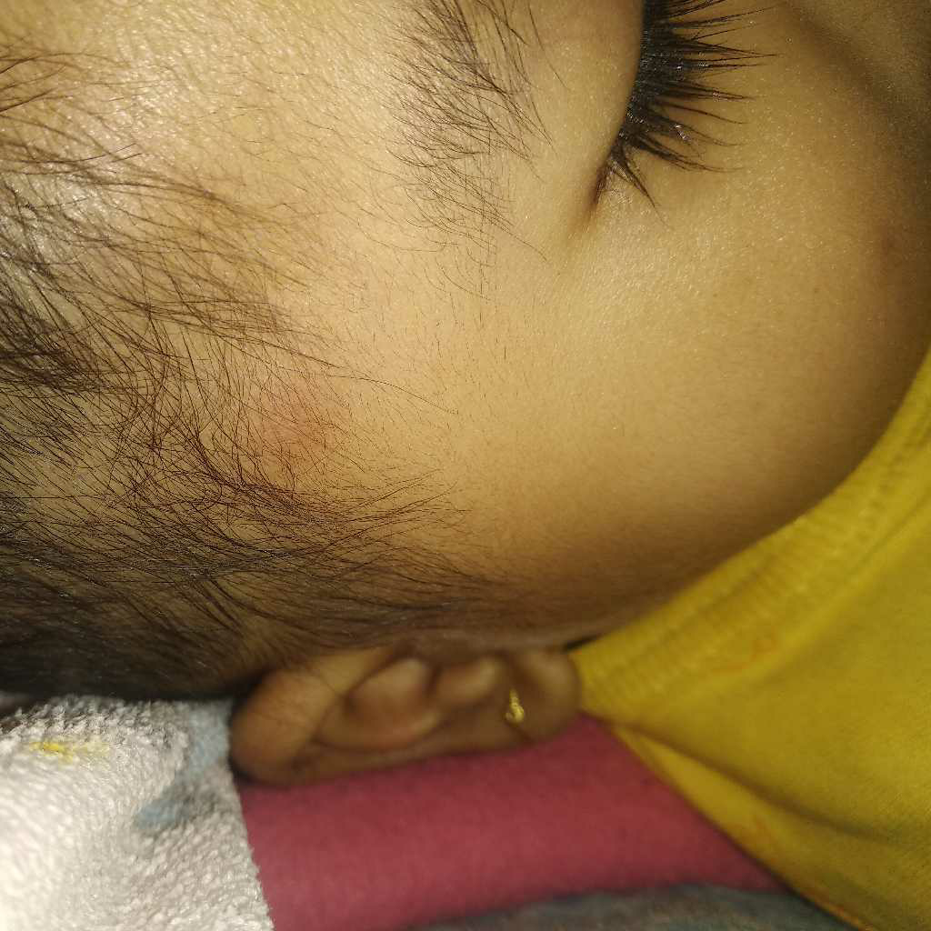 #AskTheExpert 5 months baby has got rushes like pimple occurred on his ...