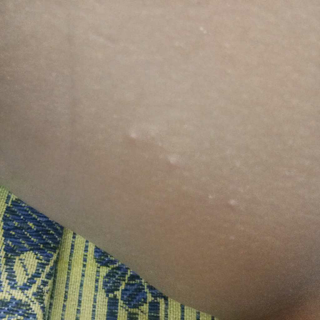 Hey doctors my baby is 5 months old n she got small pimples on stomach ...