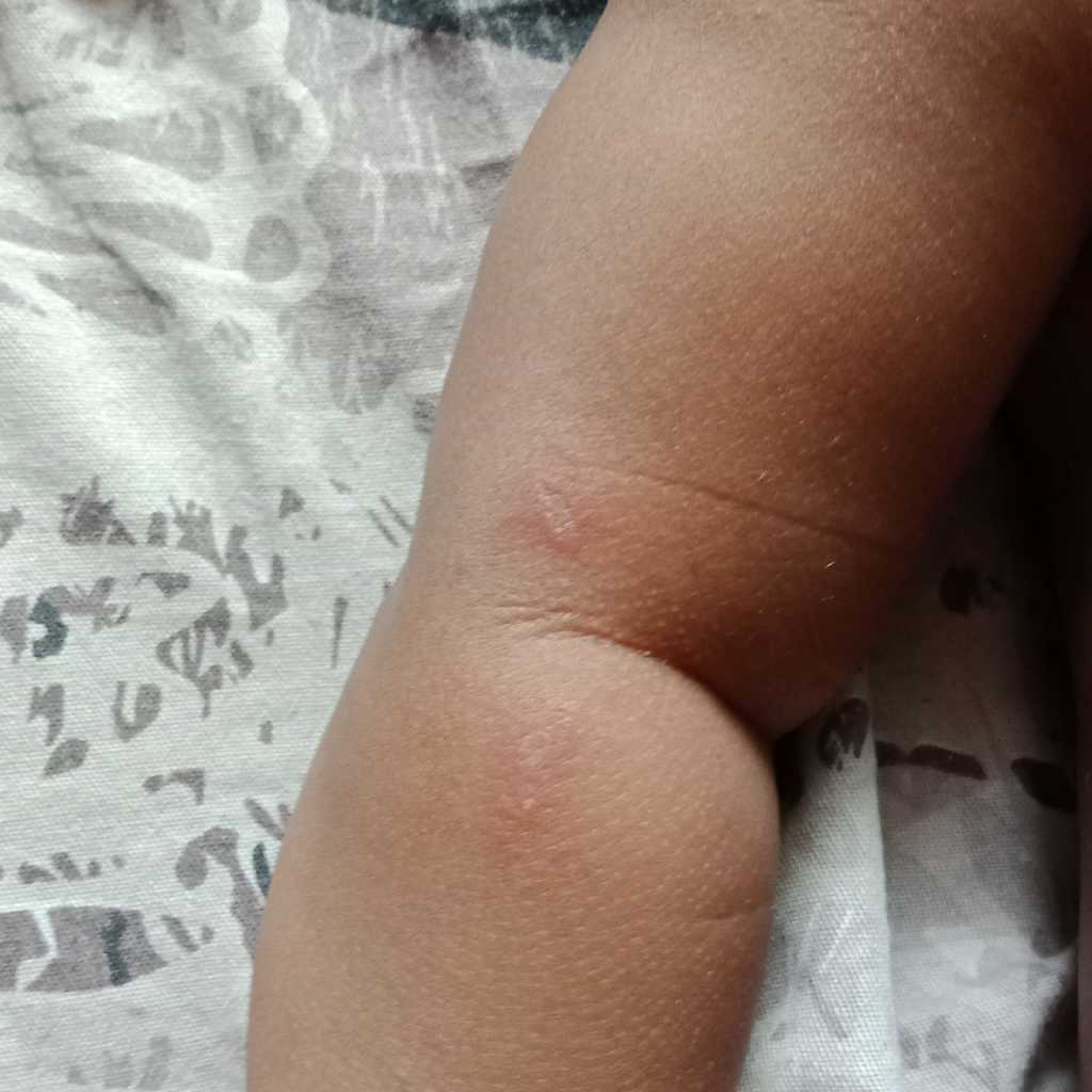 doctor my baby is 8 months old and there are some rashes on his face ...