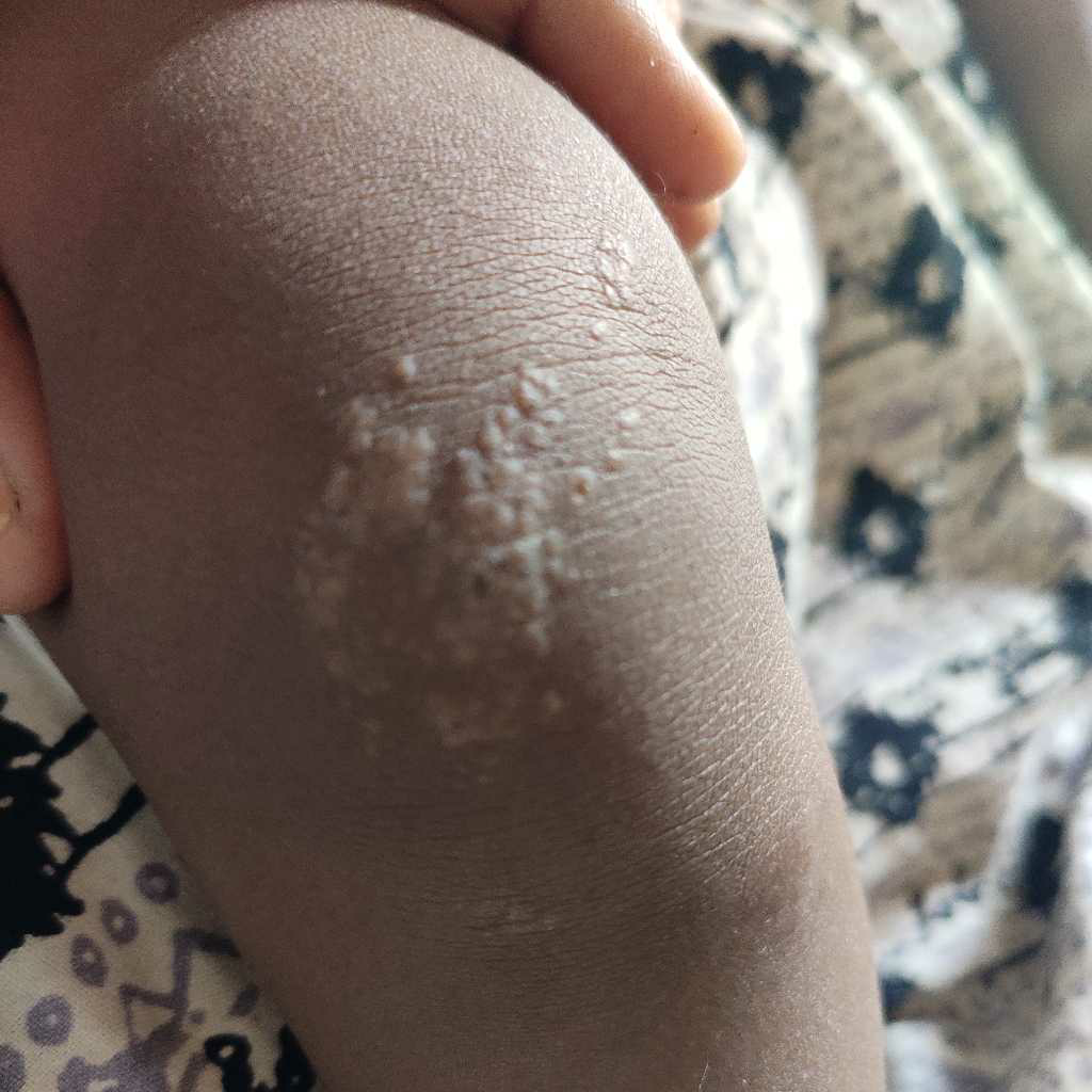 List 98 Pictures Photos Of Water On The Knee Latest