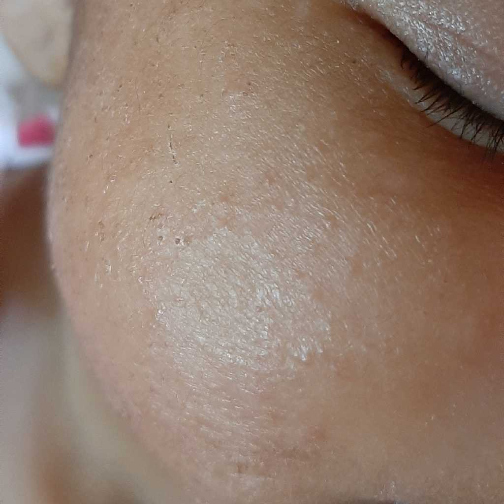 Rashes on face of 6 months old. Recently shifted to ghaziabad, got ...