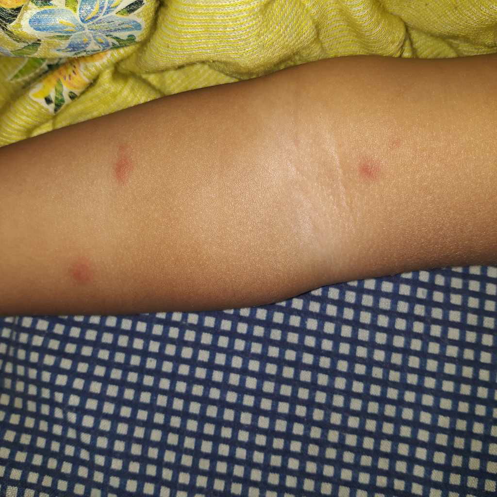 my 9 months old baby developed this type of rash on hand yesterday ...