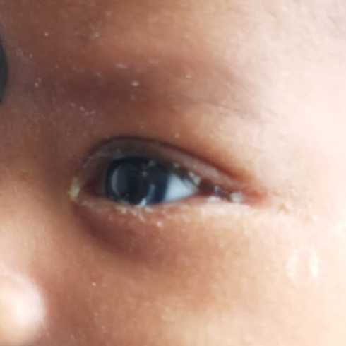 My baby’s left side eye is swelling – FirstCry Parenting