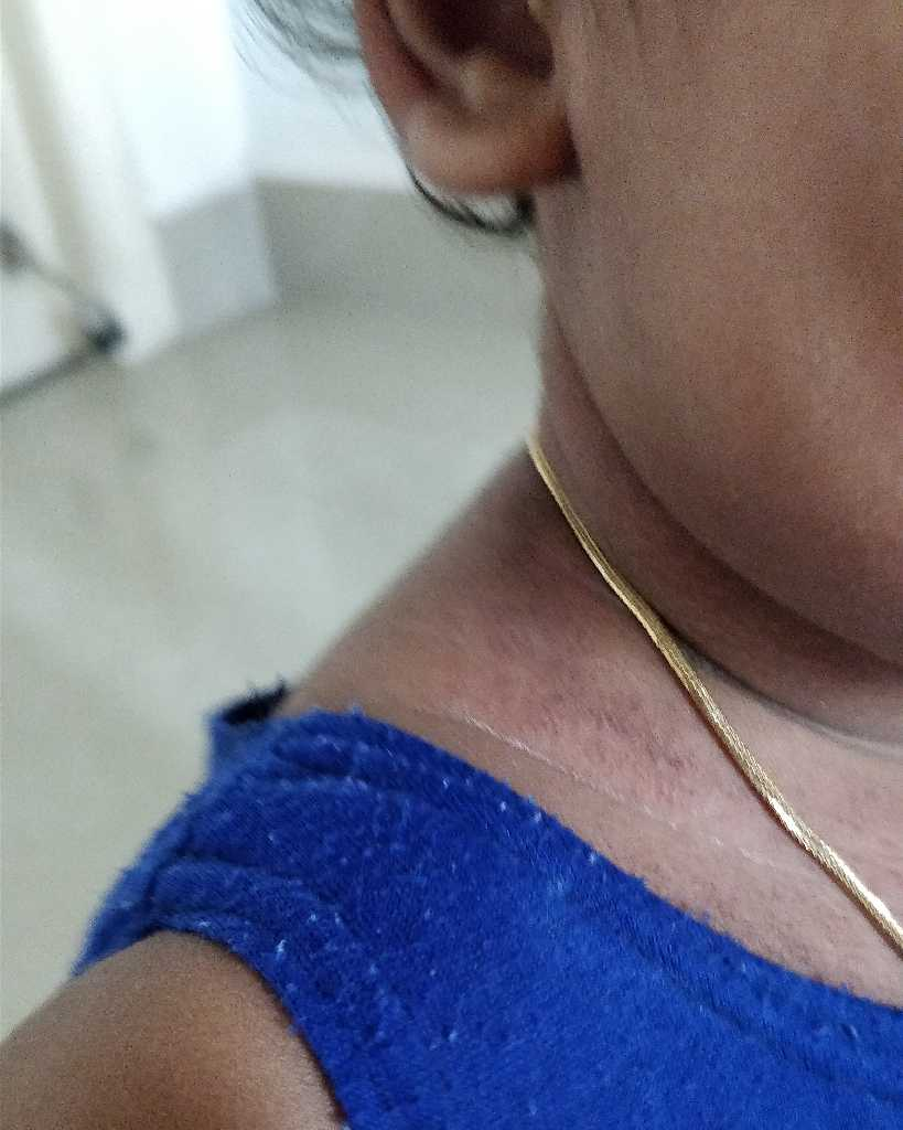 #AskTheExpert my baby is 6 months 5 days...his right shoulder skin is ...