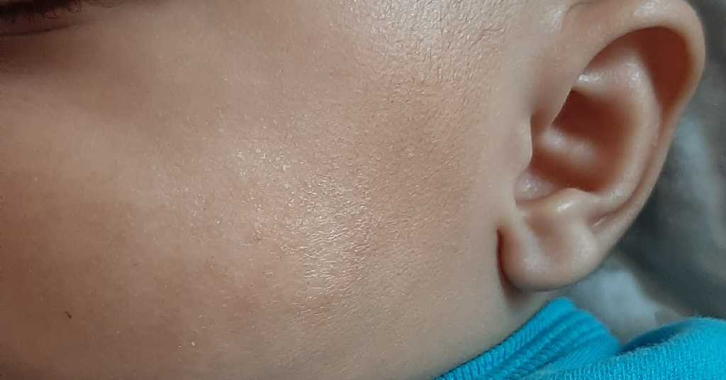 Hello, My baby is 4 months old and he has a pimple kind of rash on his ...