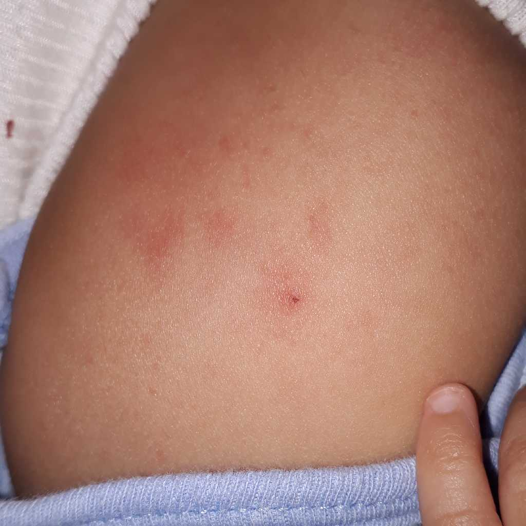 Red Rash On Chest Early Pregnancy at Howard Anson blog