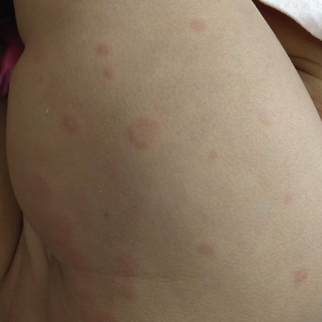 hey , my baby is 1year 2month old . from a month she got red rashes on ...