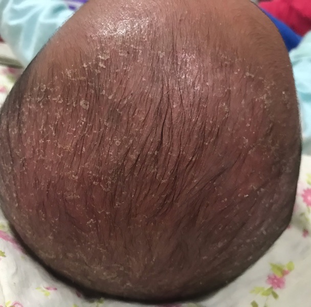 #AskTheExpert My little one has dry skin on his head and keeps ...