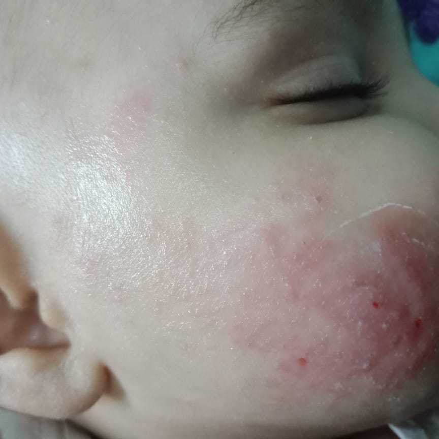 #AskTheExpert hello mam these days there are red spots on my baby cheek ...