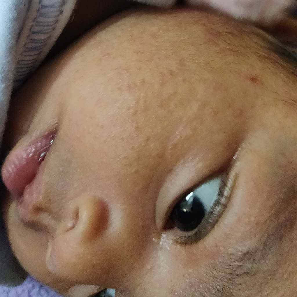 #AskTheExpert My 1 month old baby has rashes on face. Please suggest ...