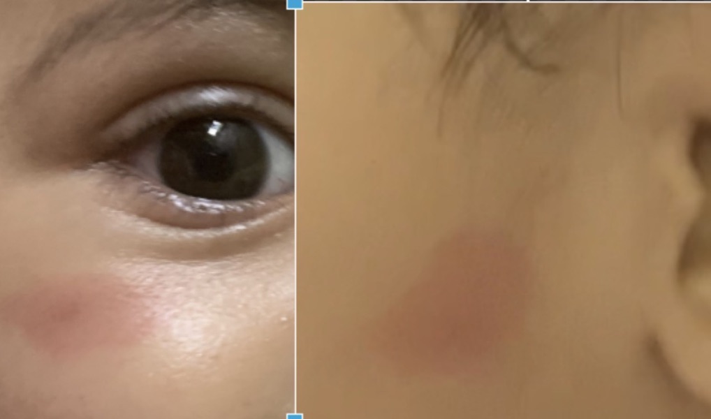 My son wake up with red eye image is attached . Any suggestions what ...