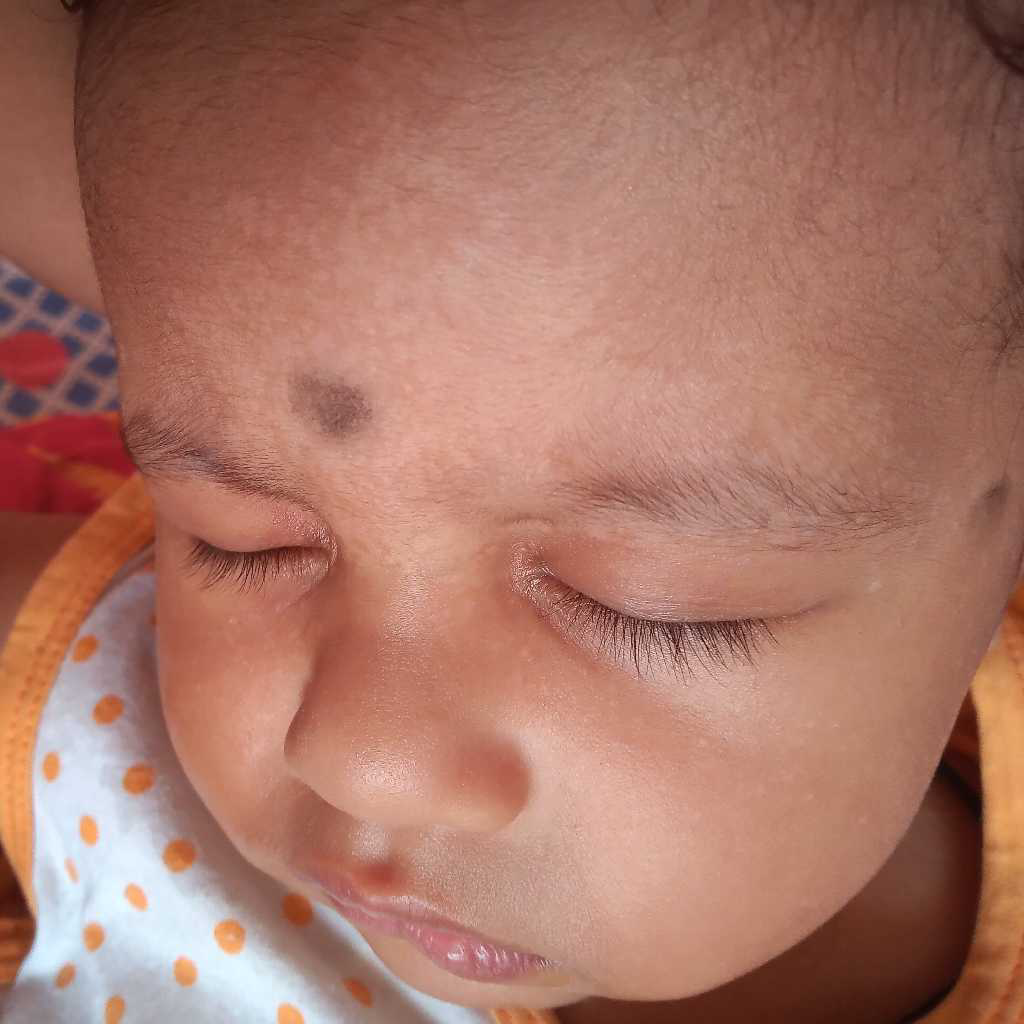 my son has skin infection on forehead as well as nose area actually ...