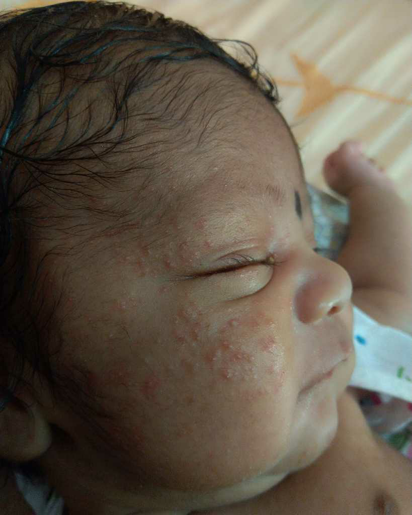 #AskTheExpert Hi Doctor, my baby development pimples all over face ...