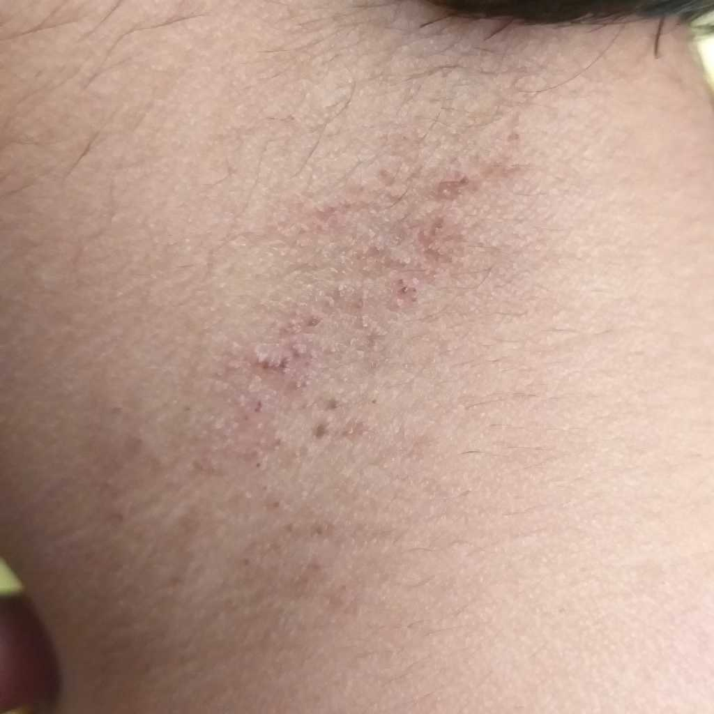 how to care skin in summer my baby age 16 months he is suffer from ...