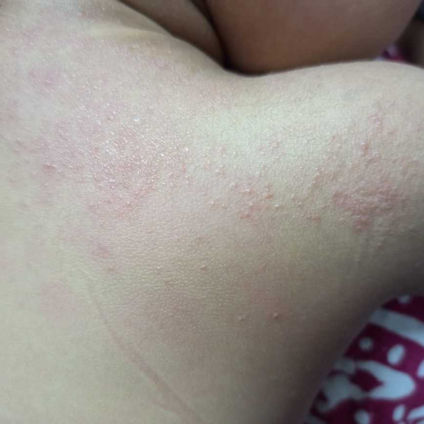 my baby boy is 1 year old and he has got this red patch on his back ...