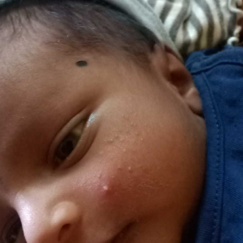 my son is 10 months old nad since birth he has this pimple/acne kinda ...