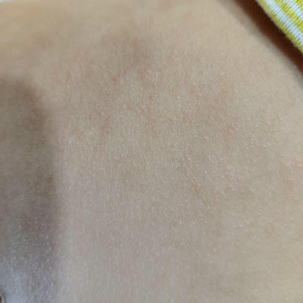 my baby has got rashes on his skin like this.. can you help with it ...