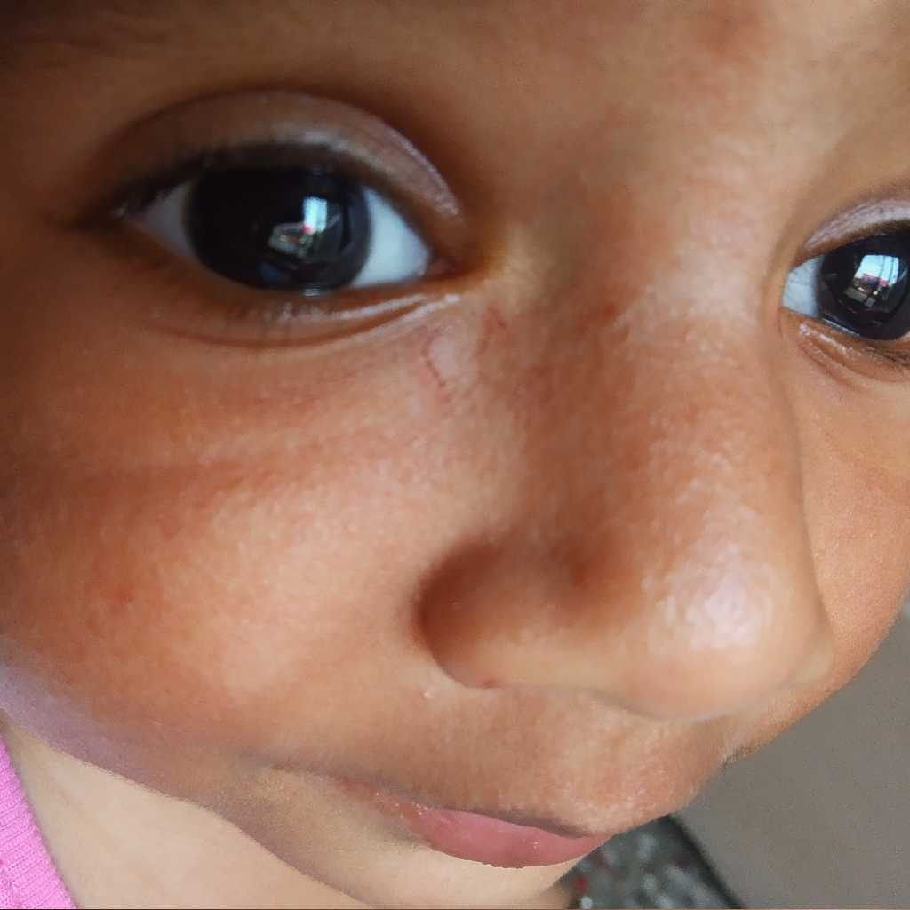 #asktheexpert . my kid is getting bumpy rashes on face and body . is ...