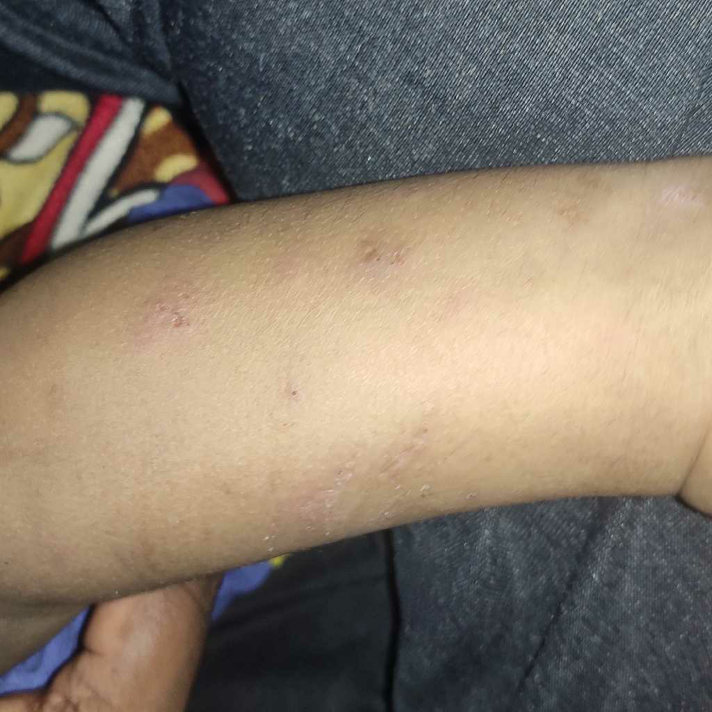 Hii my baby got this type of rash on her leg... Please help me what ...