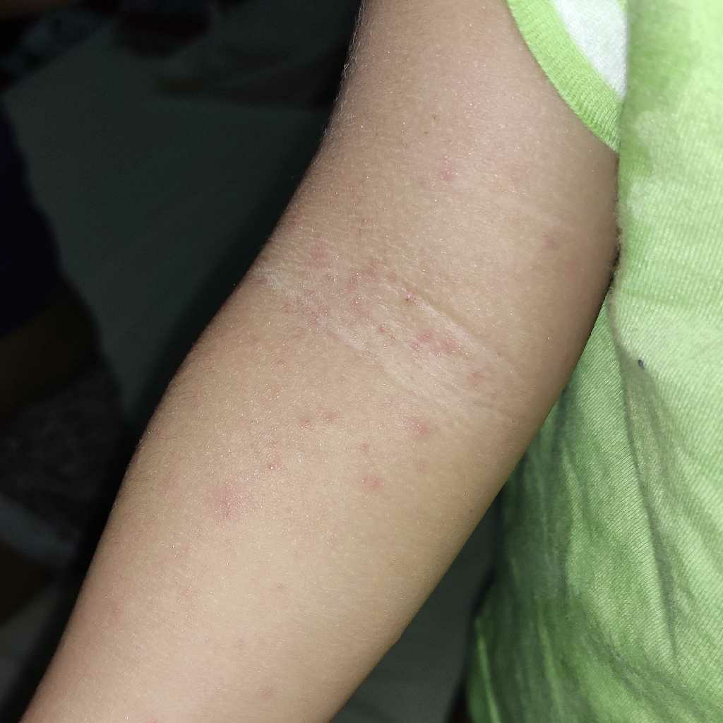 how to remove heat rash on my 1 year 4 months old daughter's back?? any ...