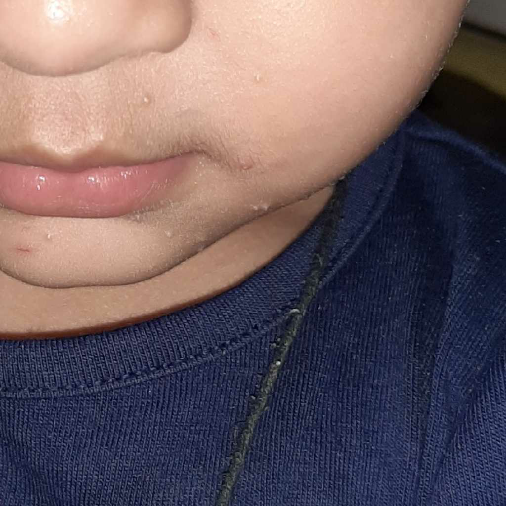 my baby is developing these small boils beside her mouth which started ...