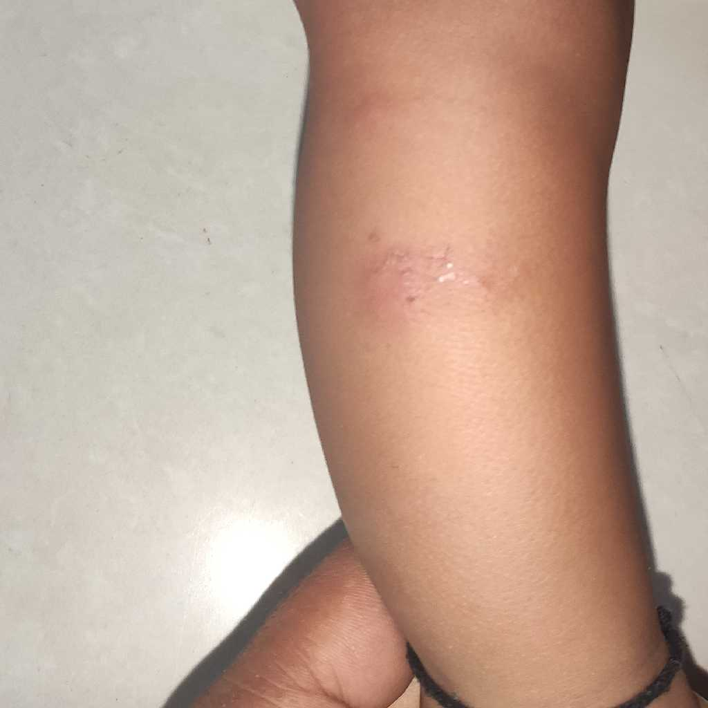 My 5 month old baby has small blisters in face, hand and leg on the ...