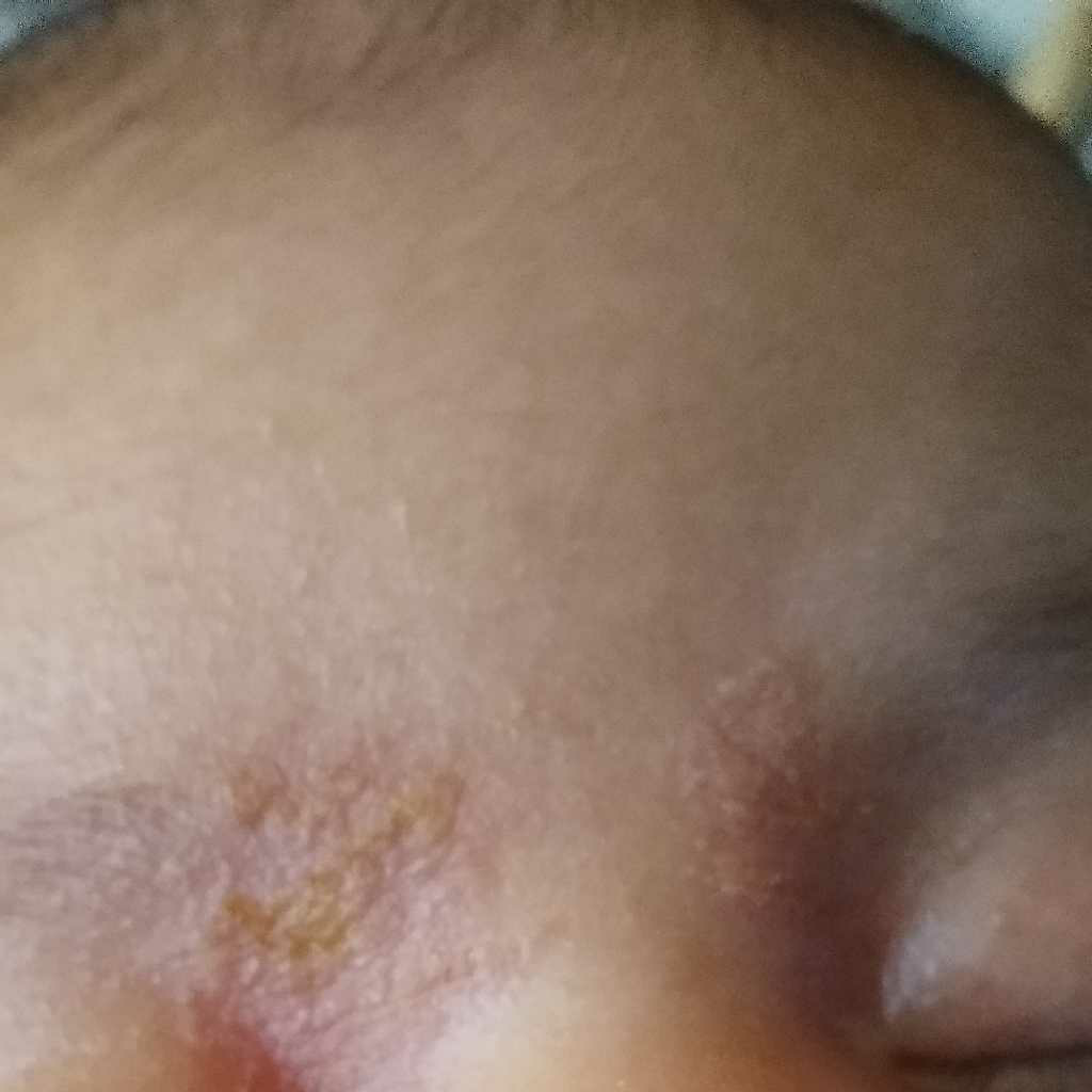 Hii my 6th month baby having red rash around the eyes. .it is spreading ...