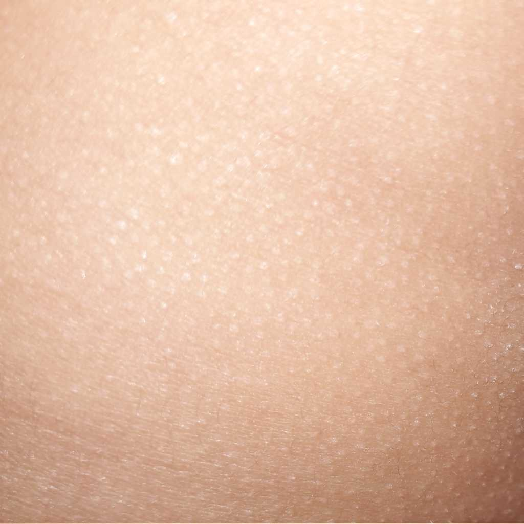 my son's all over body small small boil are there since Tuesday and ...