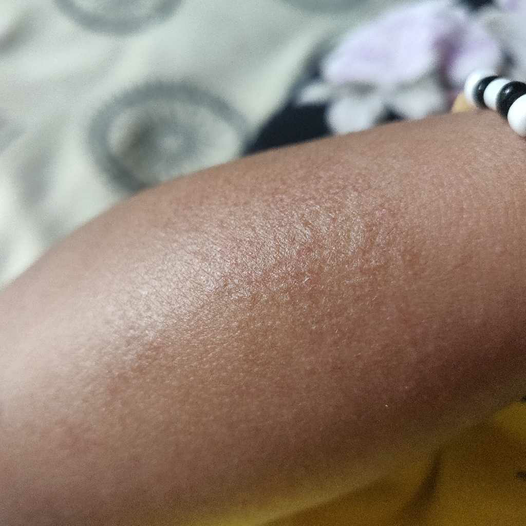 my 1 yr baby has red pimples on her face and on her hand... how to ...