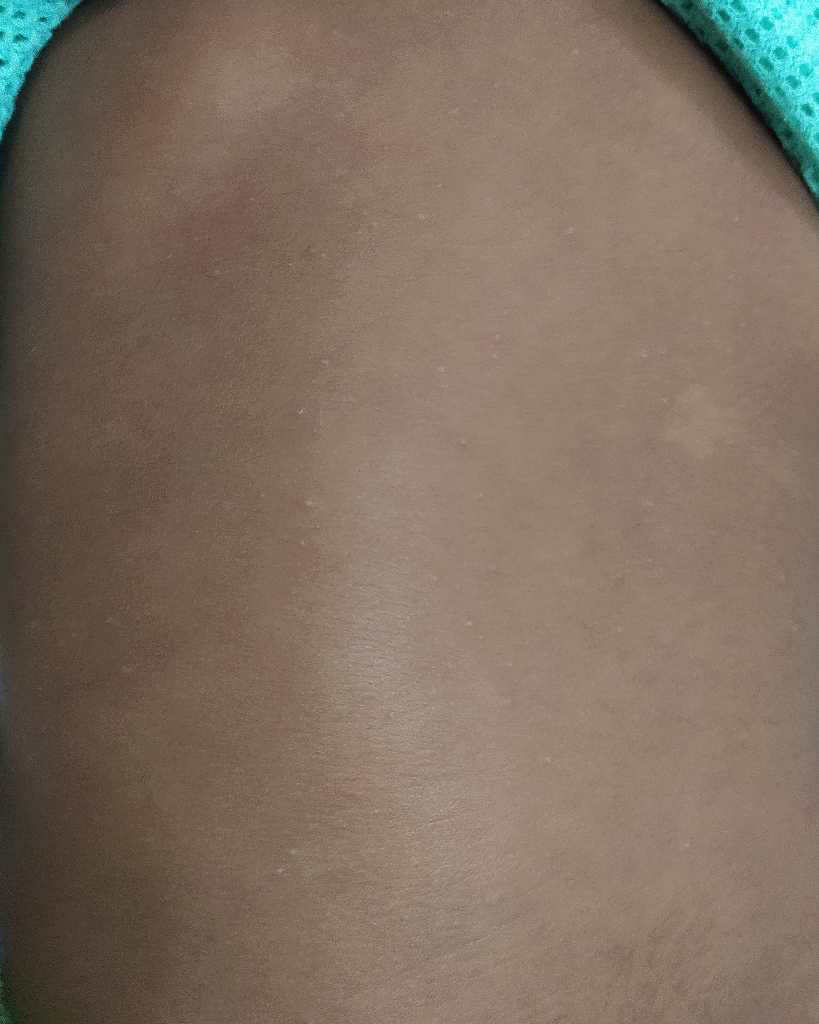 my child is having a mild rashes on face to neck no other area she was ...