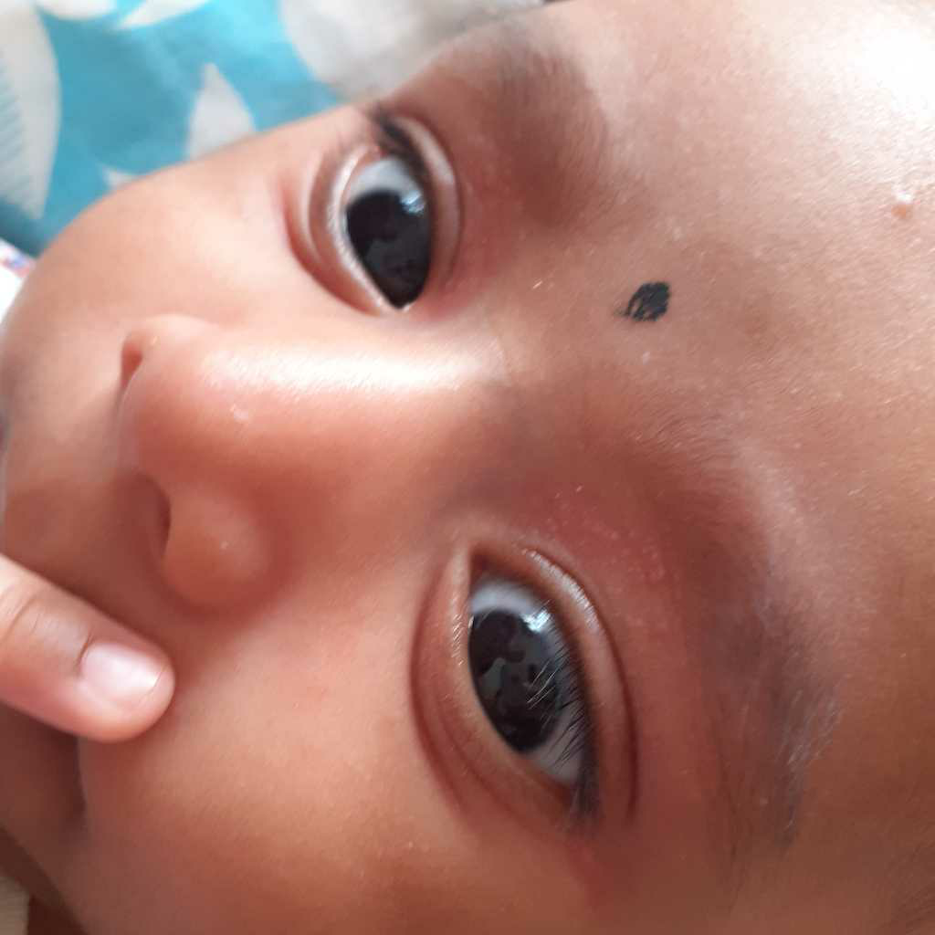 Hii my 6th month baby having red rash around the eyes. .it is spreading ...