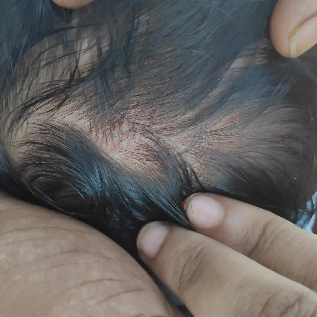 My 2.5 month baby boy has red spots on his head between hair follicles ...