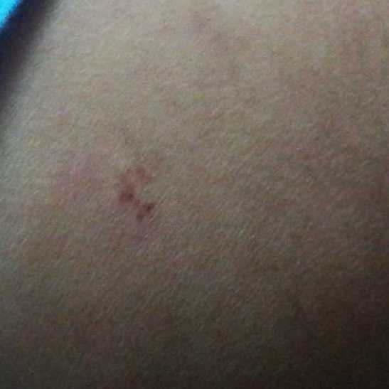 how to cure the swollen mark of bcg vaccine ? – FirstCry Parenting