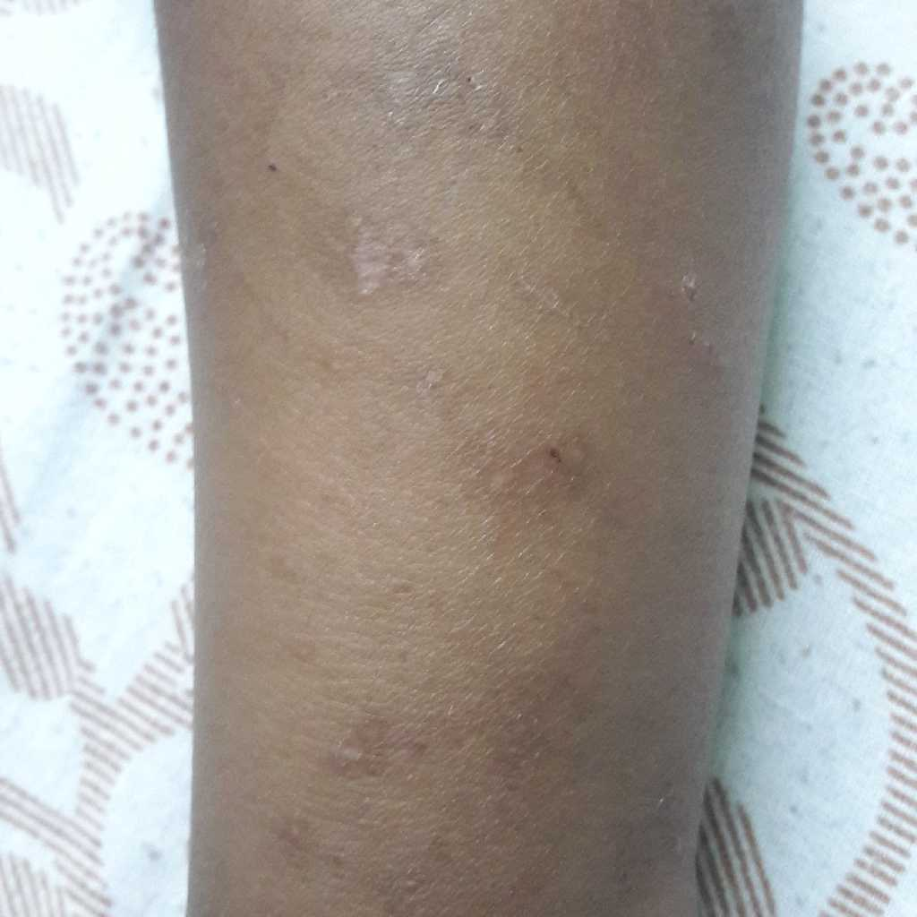 my baby is 13 month old.can phimosis can be cured by ointment or ...